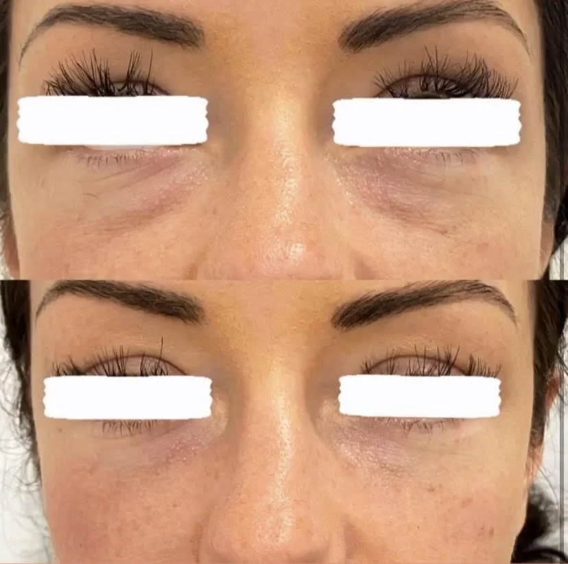 Tear Trough Treatment — Courtney Cassidy Aesthetics
