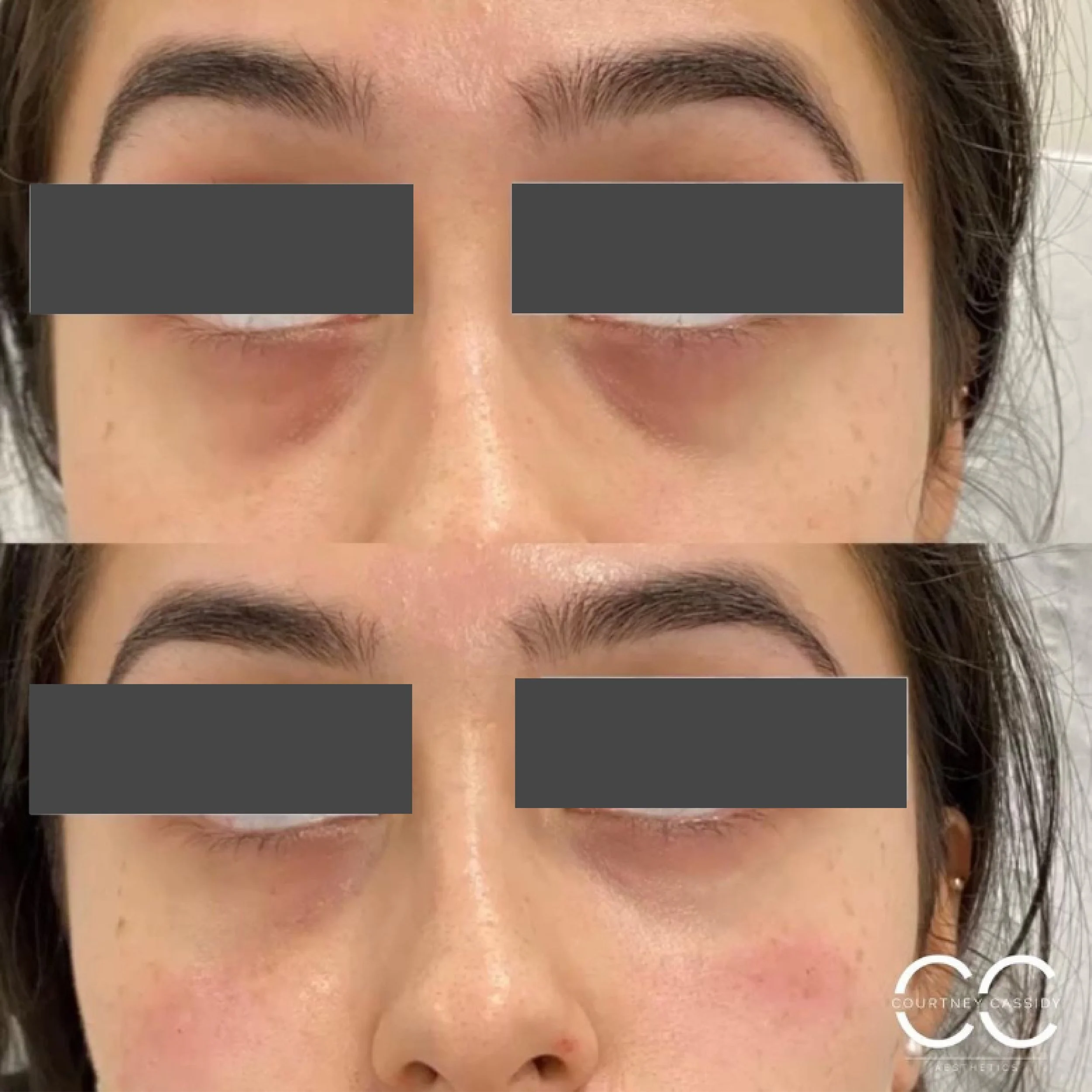 Tear Trough Treatment — Courtney Cassidy Aesthetics