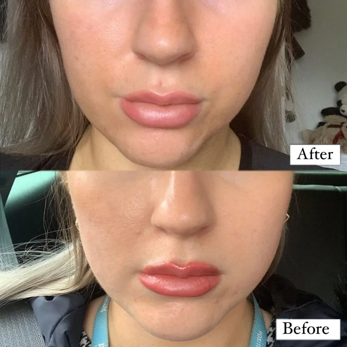 Anti Wrinkle Injections — Courtney Cassidy Aesthetics