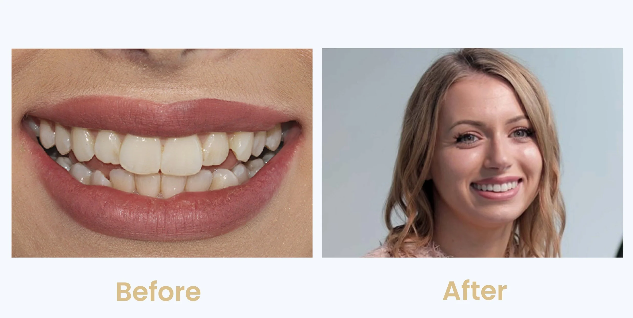 Smile Gallery — Clearbraces.ie︱Ireland's No. 1 Invisalign Provider
