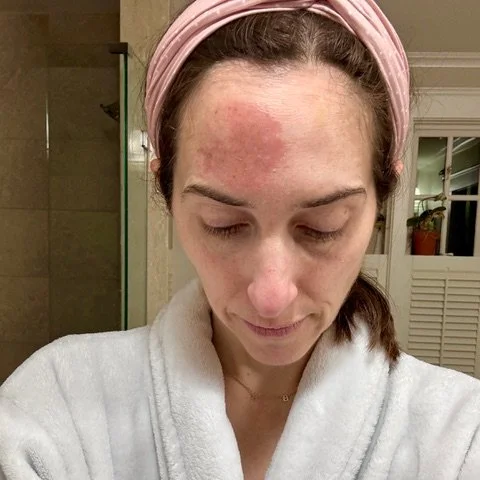 My Journey with Skin Cancer and Chemotherapy Cream — Findley Dermatology