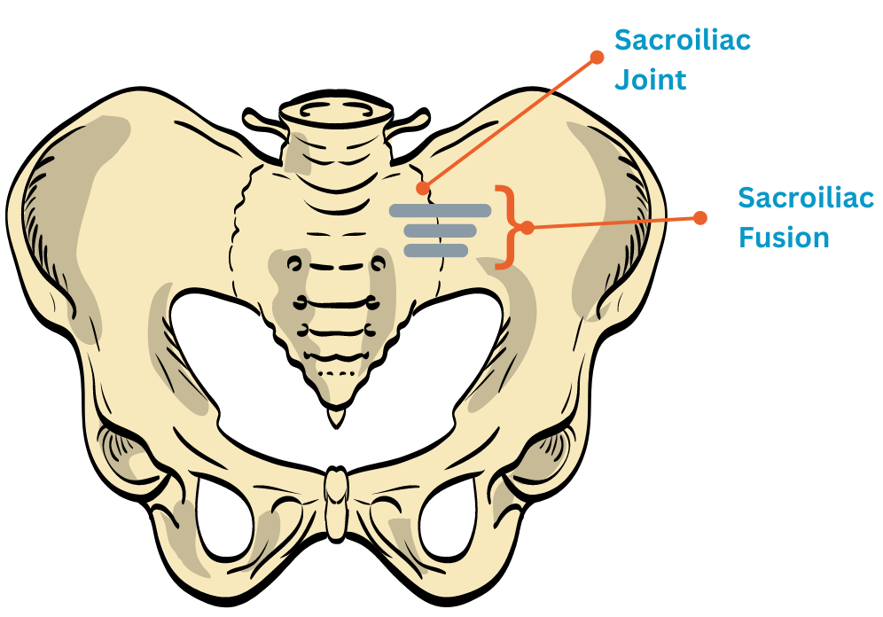 Sacroiliac Joint Fusion: Relieving Chronic Lower Back Pain — MacKay ...
