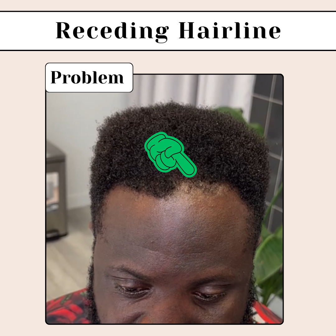 Solving Men's Hair Problems: Receding Hairline, Bald Spots, Patchy ...