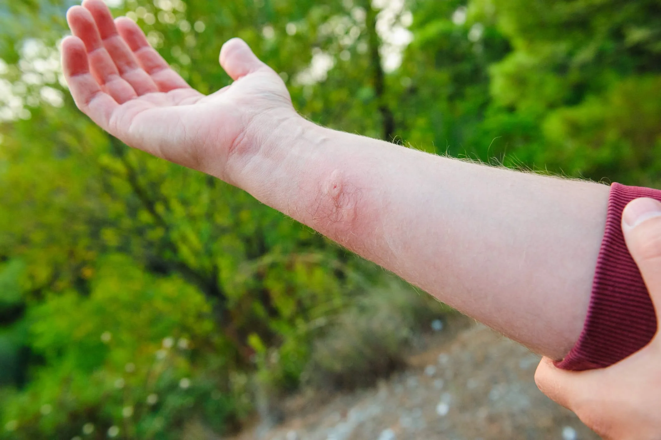 Natural Remedies for Wasp Stings: Fast & Effective Relief