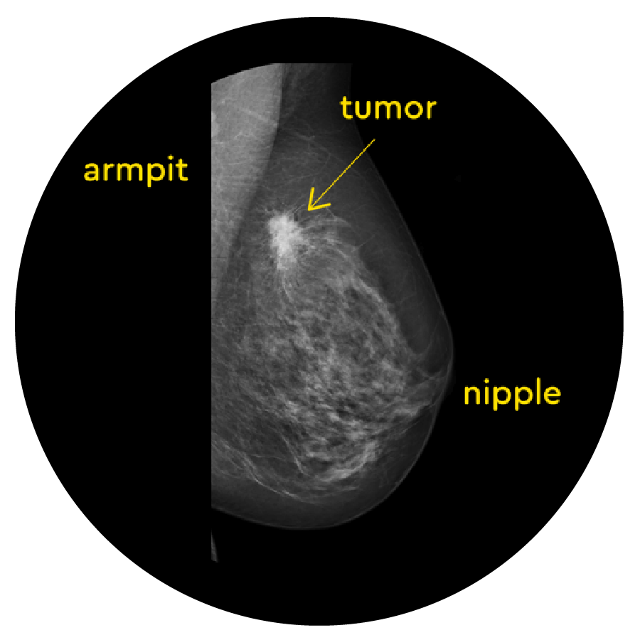 What Is A Mammogram And When To Get A Mammogram Know Your Lemons For