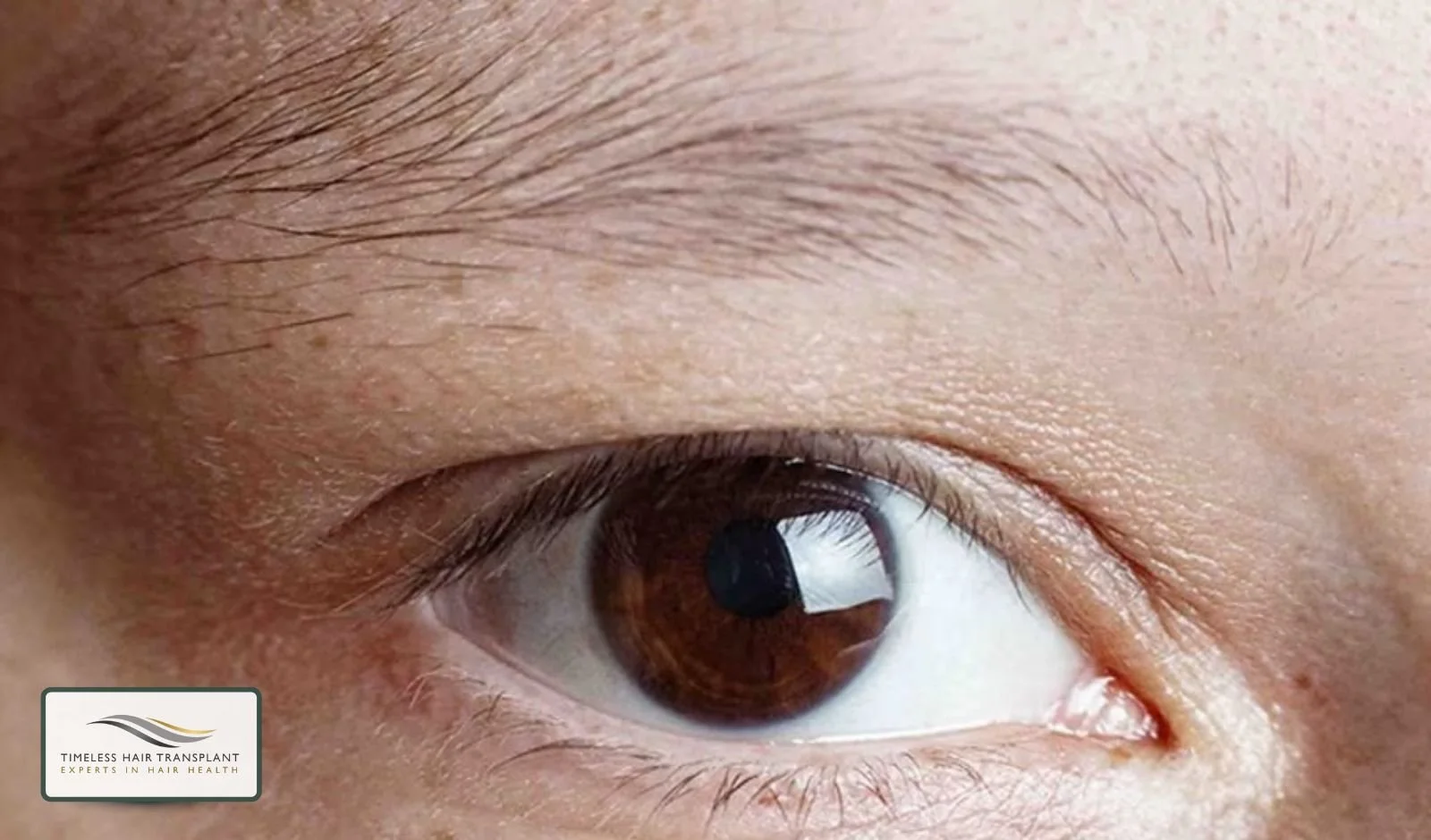 Eyebrow Hair Loss: Causes, Signs & How to Treat It — Timeless Hair ...