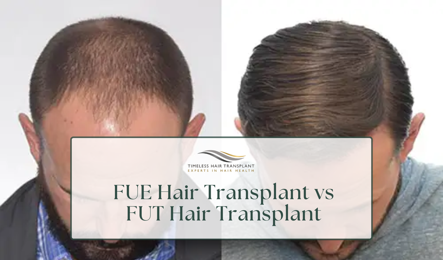 FUE Hair Transplant vs FUT Hair Transplant — Timeless Hair Transplant