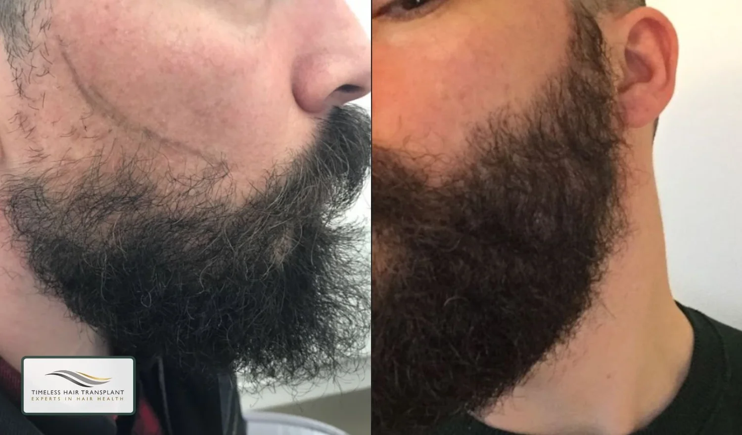 Beard Hair Transplant in the UK: Get a Fuller, Natural Beard — Timeless ...