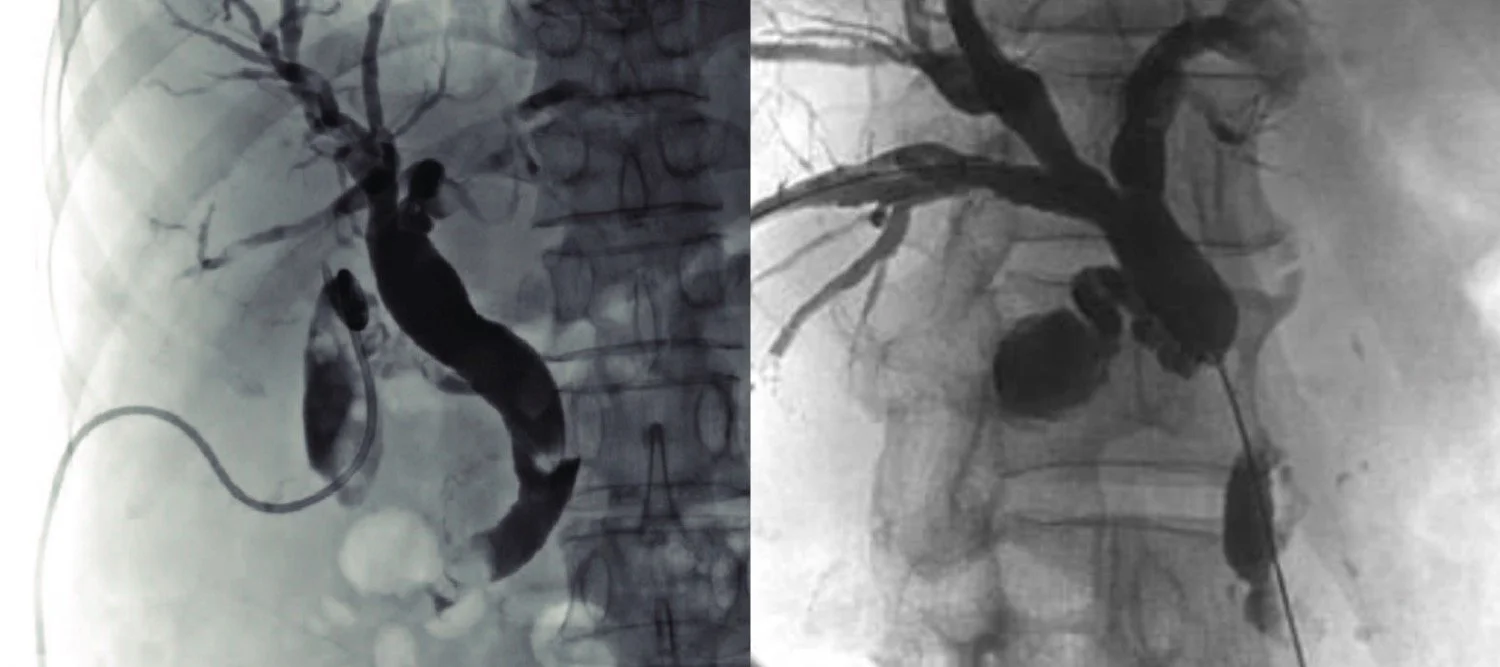 Biliary Drain and Stenting — Learn IR