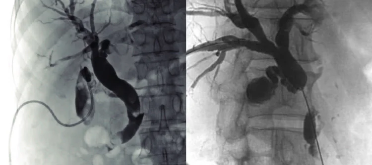 Biliary Drain and Stenting — Learn IR