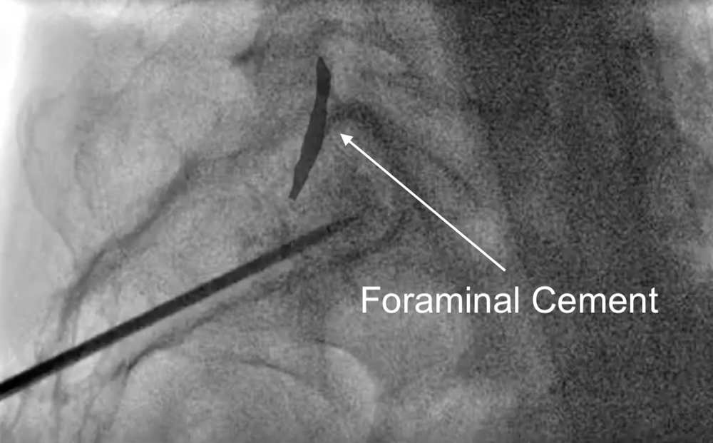 Sacroplasty — Learn IR