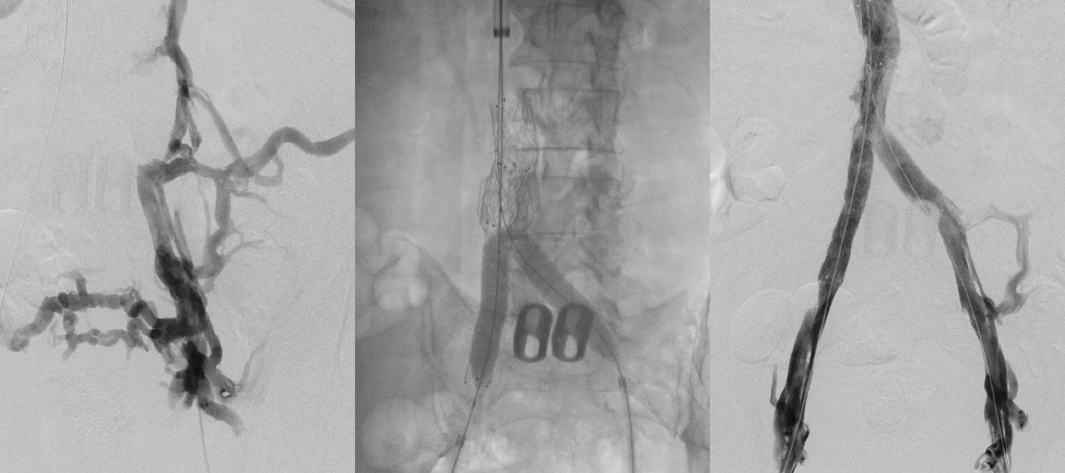 Deep Vein Thrombosis, Occlusion, and Recanalization — Learn IR