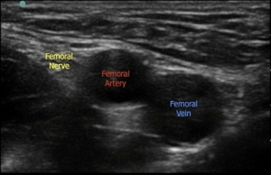 Needles and Vascular Access — Learn IR