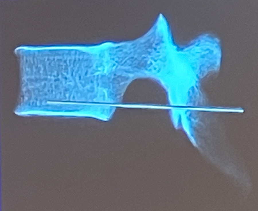 Vertebral Augmentation — Learn IR