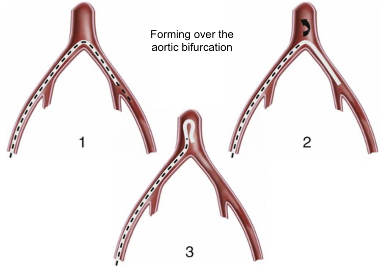 Wires, Catheters, and Sheaths — Learn IR