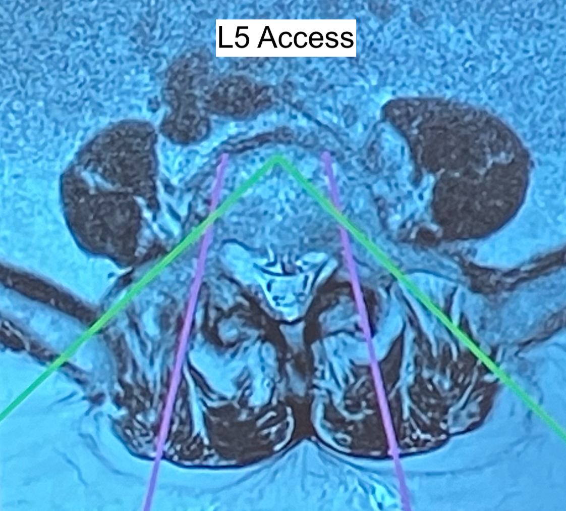 Vertebral Augmentation — Learn IR