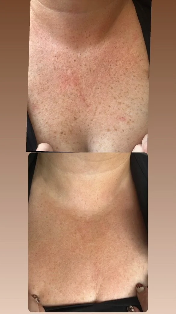 IPL Photofacial — H2H Medical Wellness