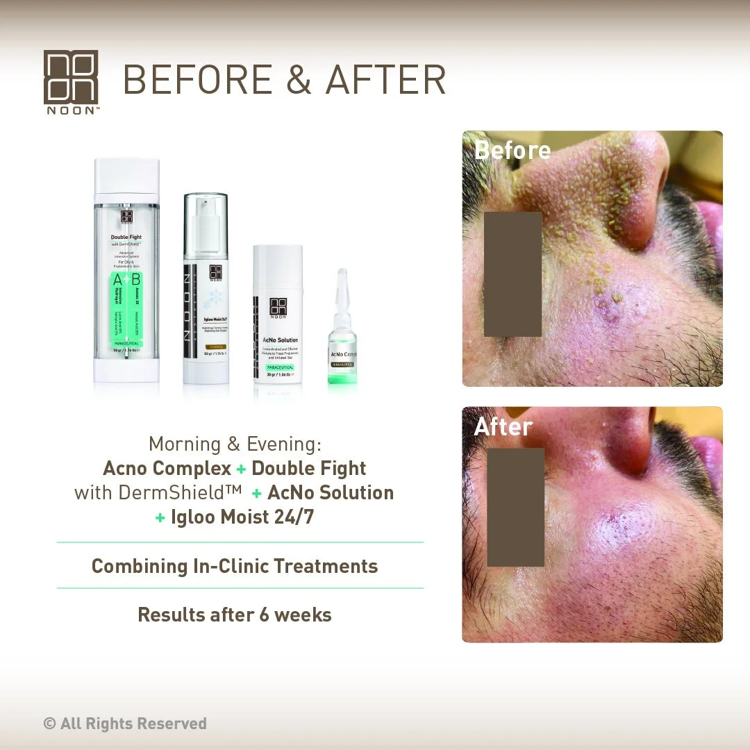 SHOP Noon Aesthetics with Nurse V — Nurse V