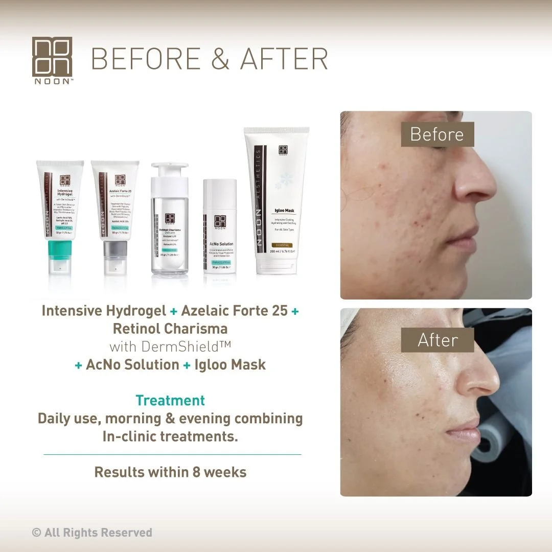 SHOP Noon Aesthetics with Nurse V — Nurse V