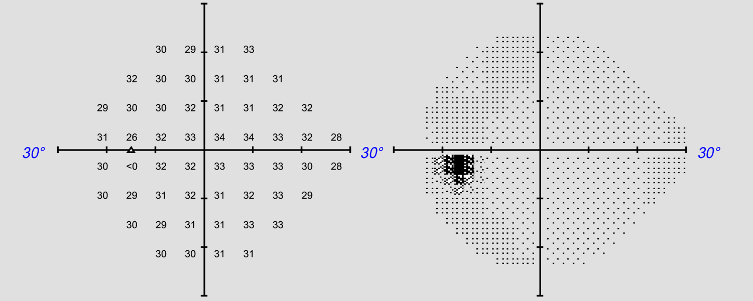Henson Visual Field Analyser — Peepers Opticians