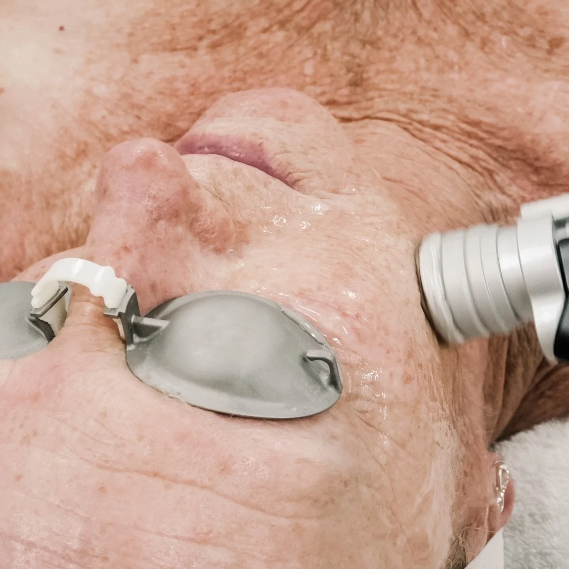 Laser Skin Treatments — BOCABA MEDSPA