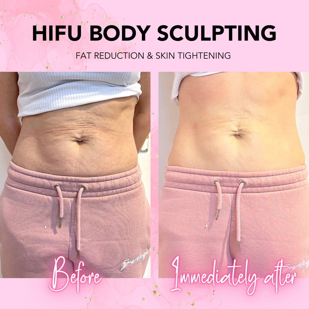 HIFU Skin Tightening Rejuvenate Now Book Today Bodylicious HIFU Skin Tightening Rejuvenate Now Book Today Bodylicious