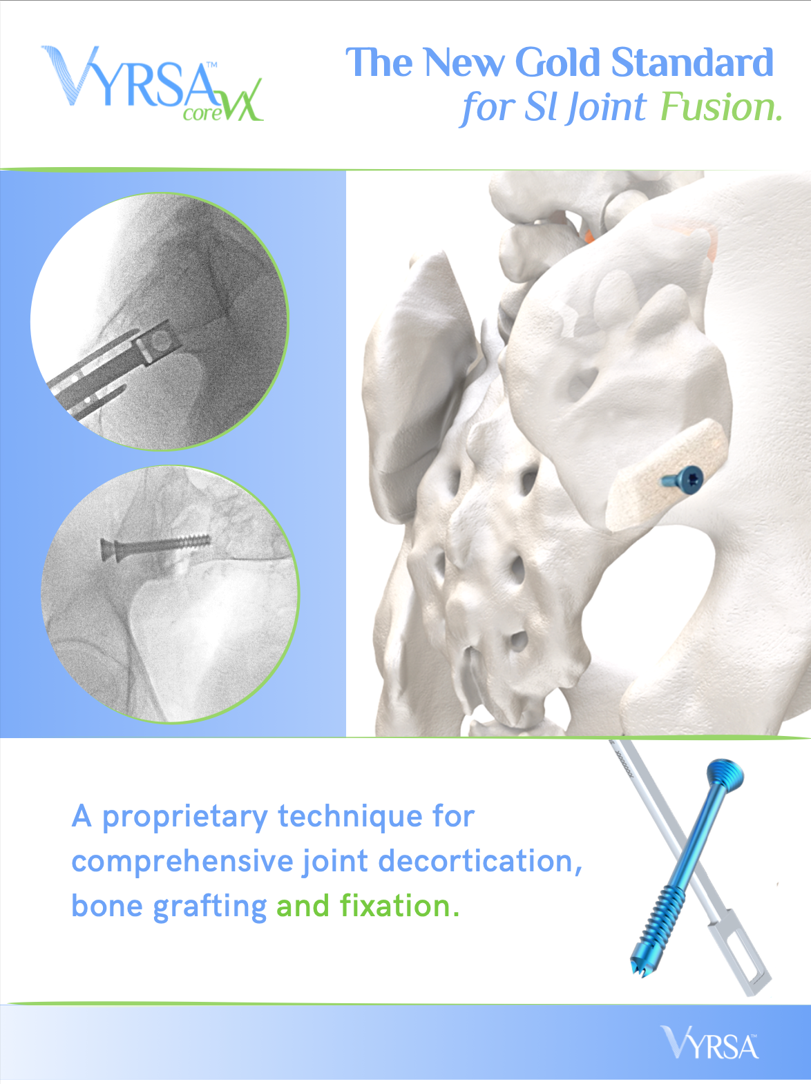 VYRSA SI JOINT FUSION SYSTEMS