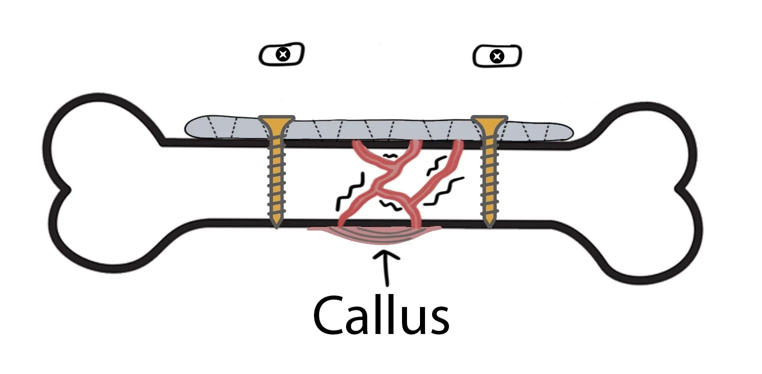 How Orthopedic Surgeons Fix Bones - Part 2 — Dr. Nick Golinvaux