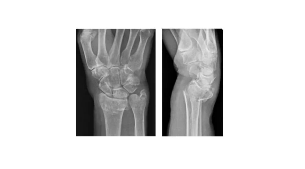 Wrist Fracture (Distal Radius Fracture) | Denver, Colorado — Dr. Nick ...