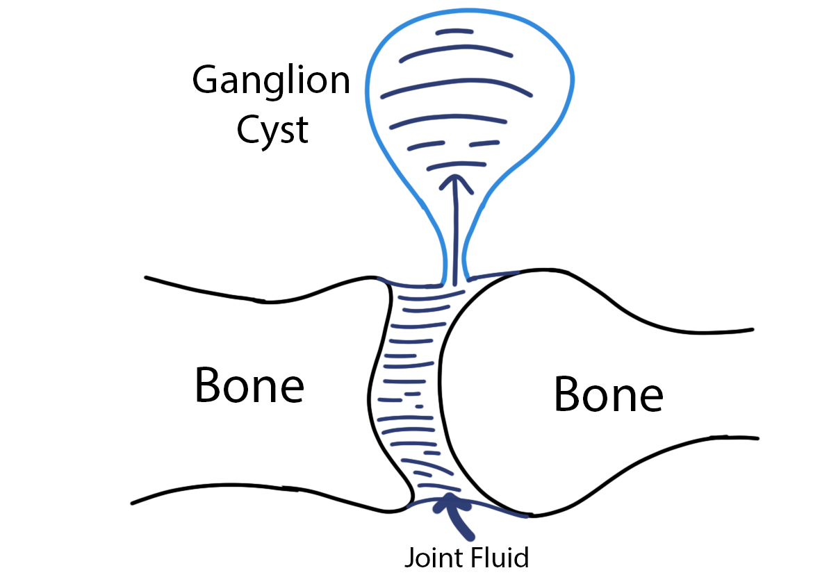 Ganglion Cyst of the Wrist and Hand | Denver, Colorado — Dr. Nick Golinvaux