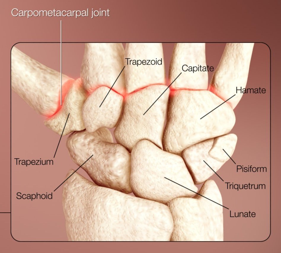 What Is A Scaphoid Fracture? 5 Facts Every Patient Must Know — Dr. Nick ...