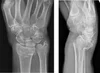 I Have A Broken Wrist: A Primer on Distal Radius Fracture Surgery — Dr ...