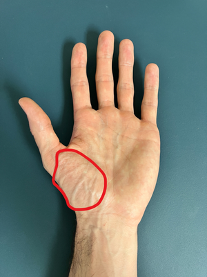 What Is Thumb CMC Arthritis? The Ultimate Guide For Patients — Dr. Nick ...