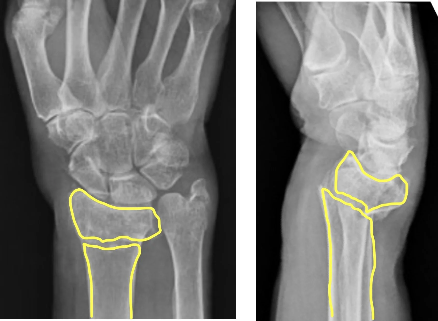 A Patient’s Guide to Distal Radius Fractures — Dr. Nick Golinvaux
