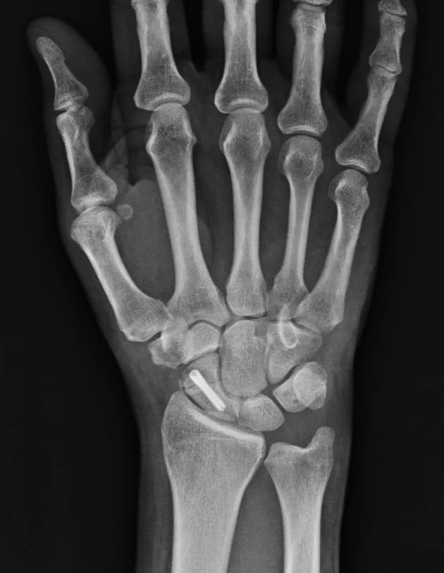 Don’t Ignore Wrist Pain — What To Know About Scaphoid Fractures — Dr ...