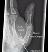 What Is Thumb CMC Arthritis? The Ultimate Guide For Patients — Dr. Nick ...