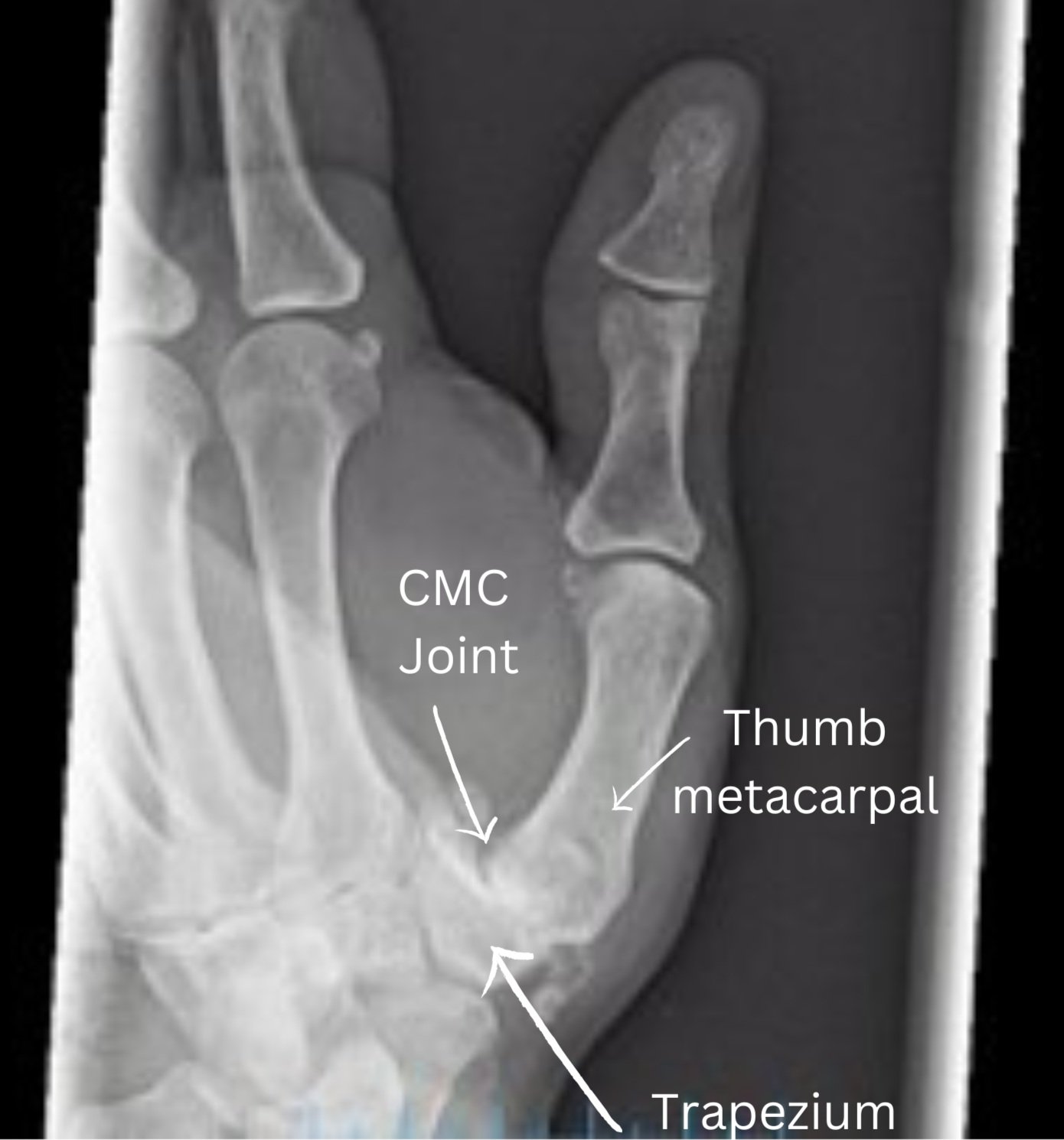 What Is Thumb CMC Arthritis? The Ultimate Guide For Patients — Dr. Nick ...