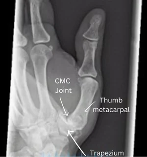 What Is Thumb CMC Arthritis? The Ultimate Guide For Patients — Dr. Nick ...
