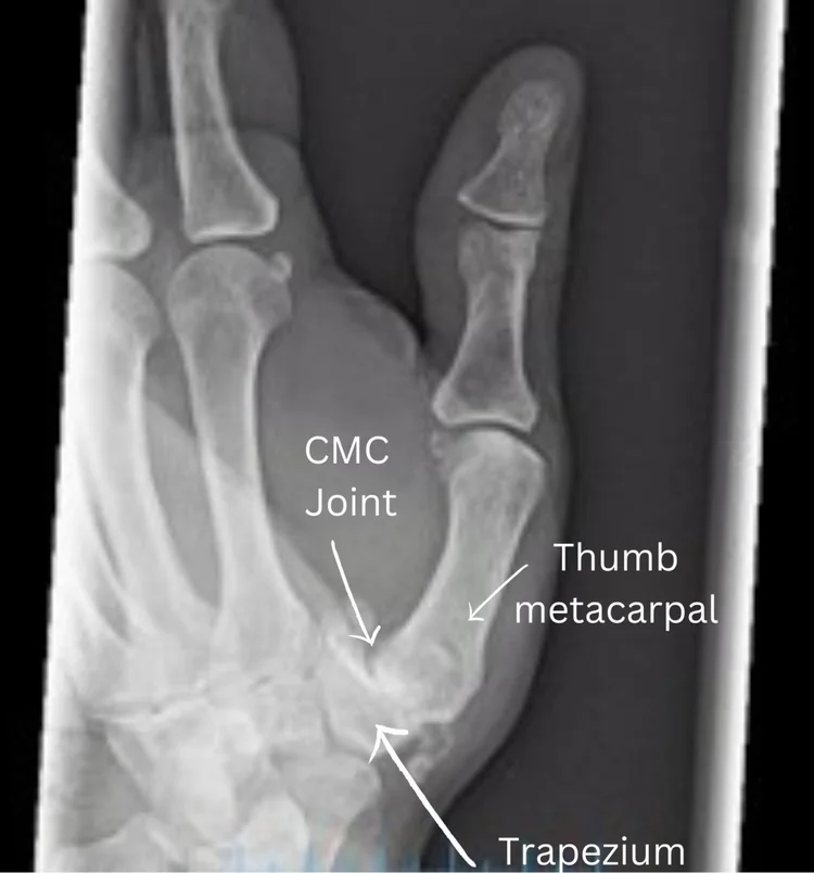 What Is Thumb CMC Arthritis? The Ultimate Guide For Patients — Dr. Nick ...