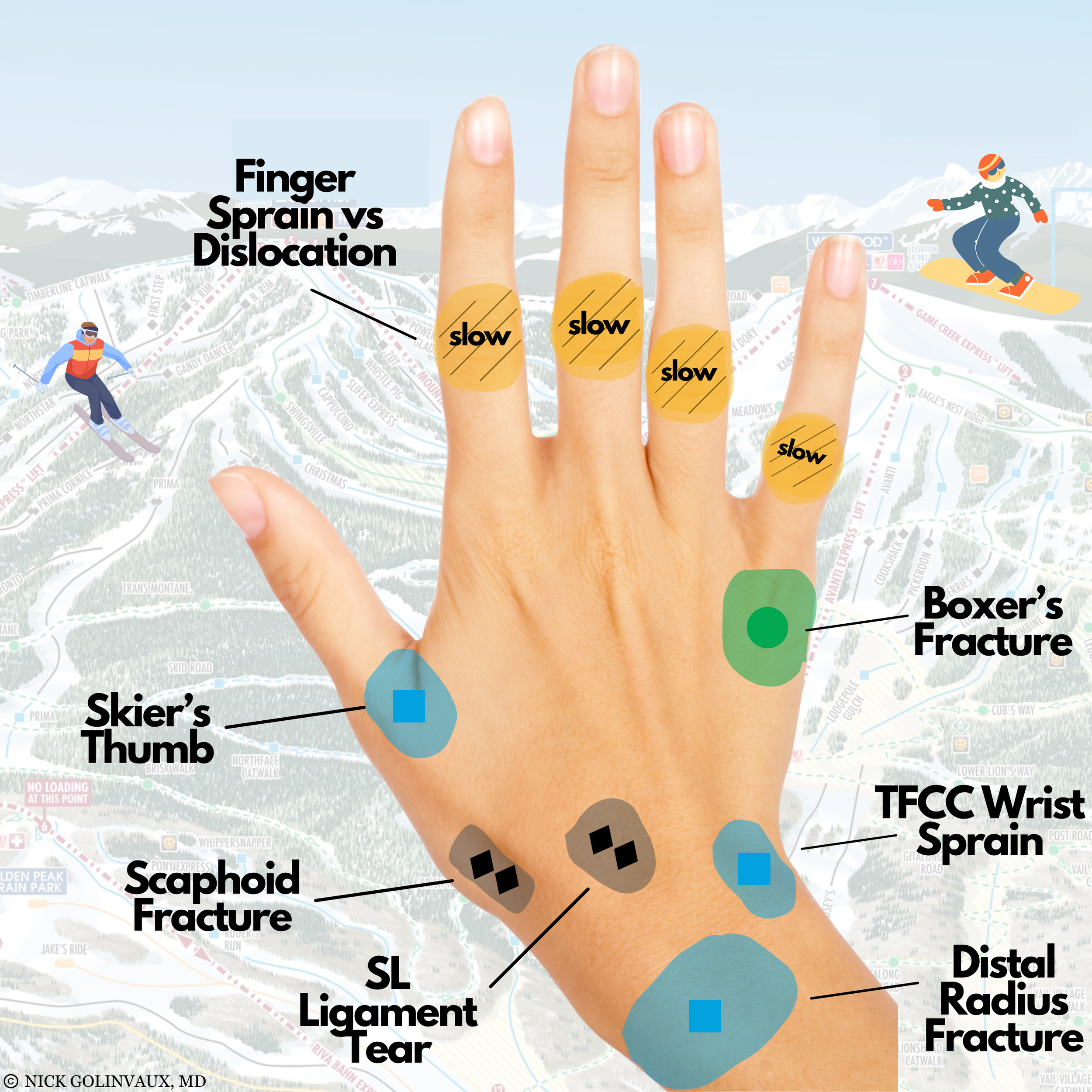 Pocket Guide: Ski and Snowboard Injuries — Dr. Nick Golinvaux