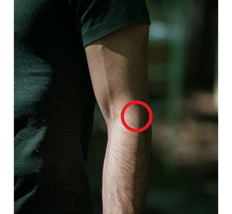 Tennis Elbow (Lateral Epicondylitis) | Denver, Colorado — Dr. Nick ...