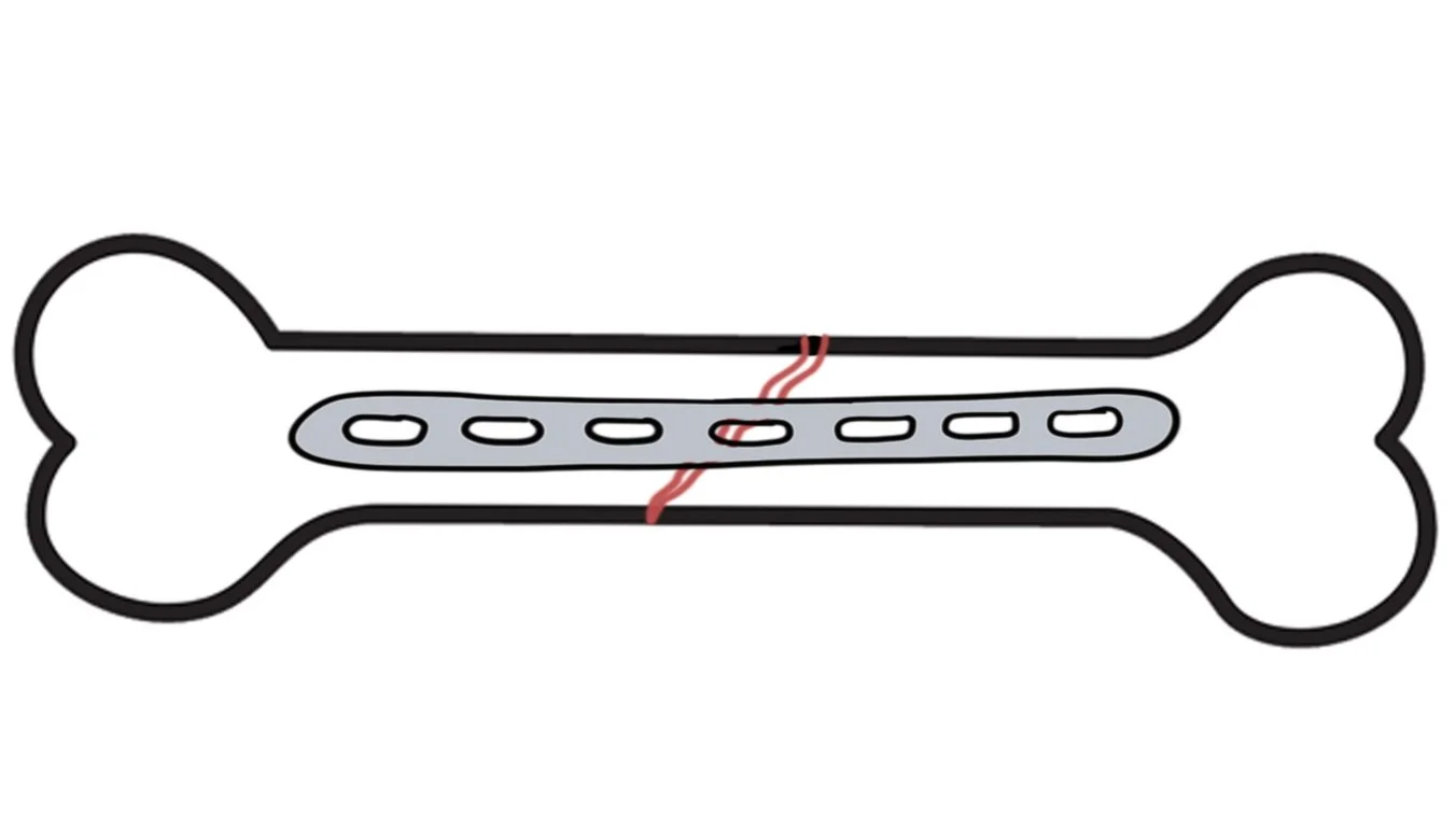 How Orthopedic Surgeons Fix Bones - Part 1 — Dr. Nick Golinvaux