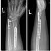 How Orthopedic Surgeons Fix Bones - Part 1 — Dr. Nick Golinvaux