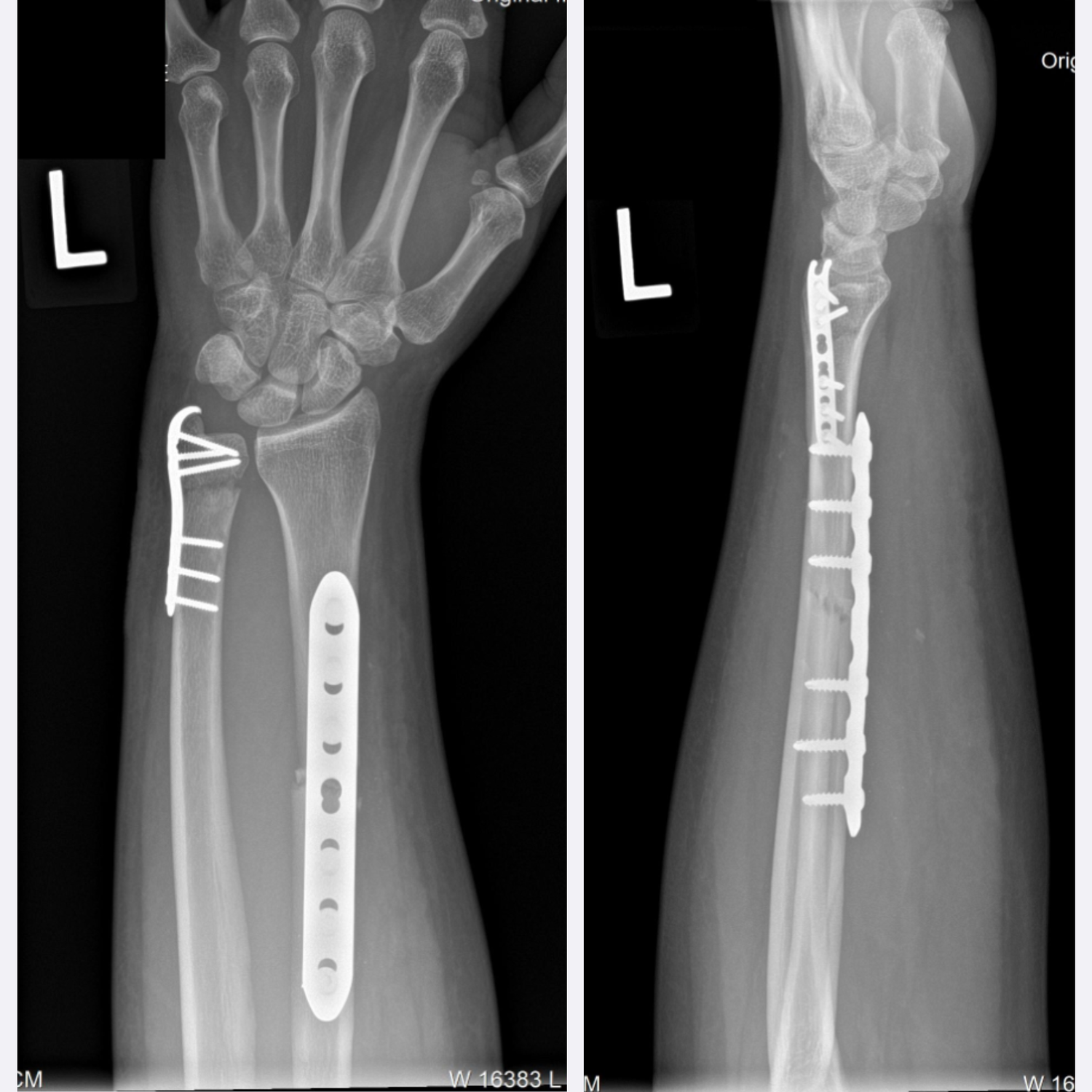 How Orthopedic Surgeons Fix Bones - Part 1 — Dr. Nick Golinvaux