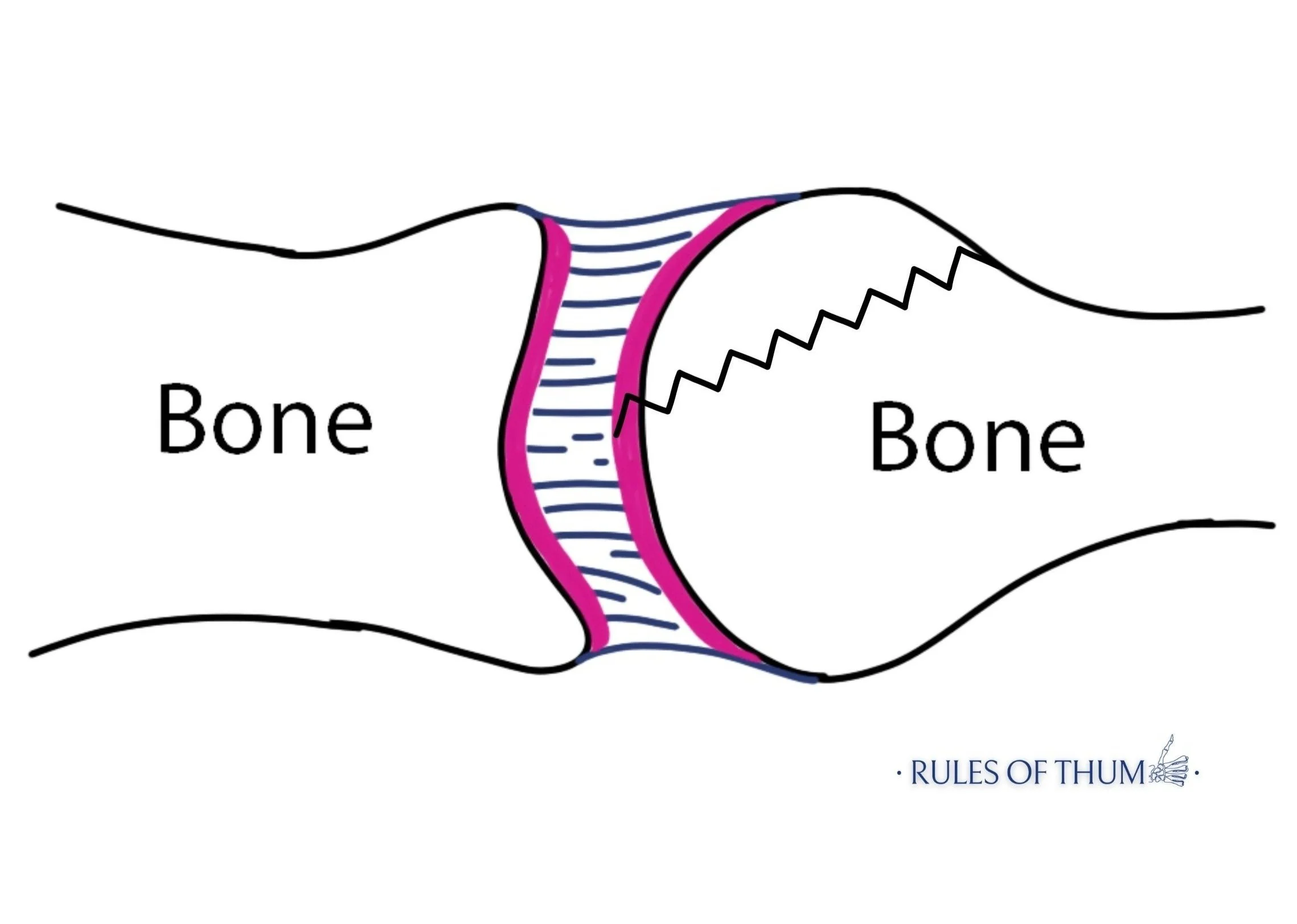 What’s the Difference Between a Fracture and a Broken Bone? — Dr. Nick ...