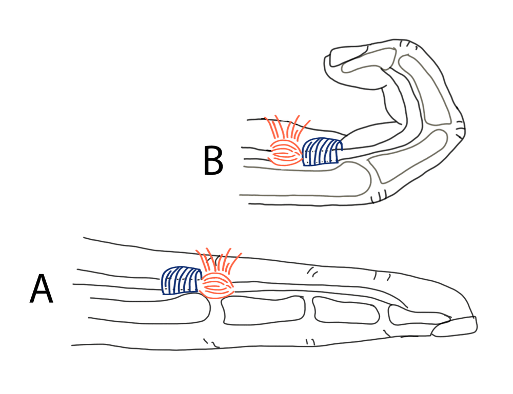Trigger Finger Steroid Injections: Are They Worth It? — Dr. Nick Golinvaux