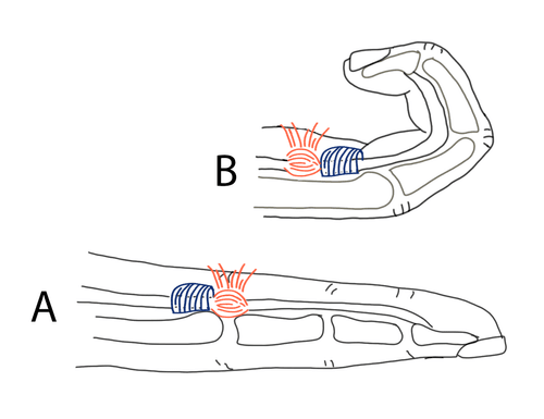 Trigger Finger Steroid Injections: Are They Worth It? — Dr. Nick Golinvaux