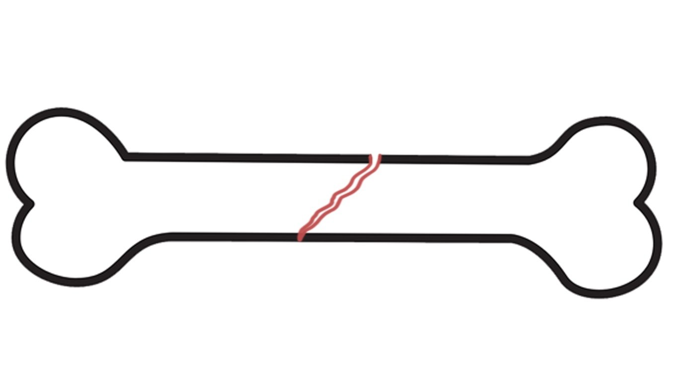 How Orthopedic Surgeons Fix Bones - Part 1 — Dr. Nick Golinvaux