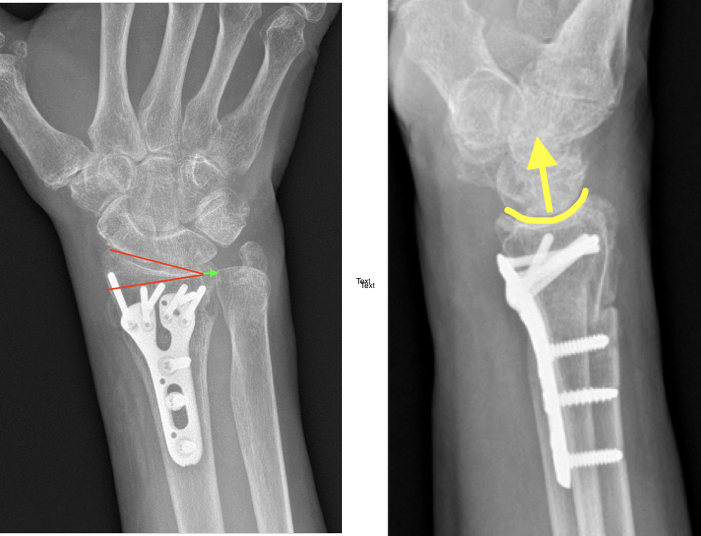 I Have A Broken Wrist: A Primer on Distal Radius Fracture Surgery — Dr ...