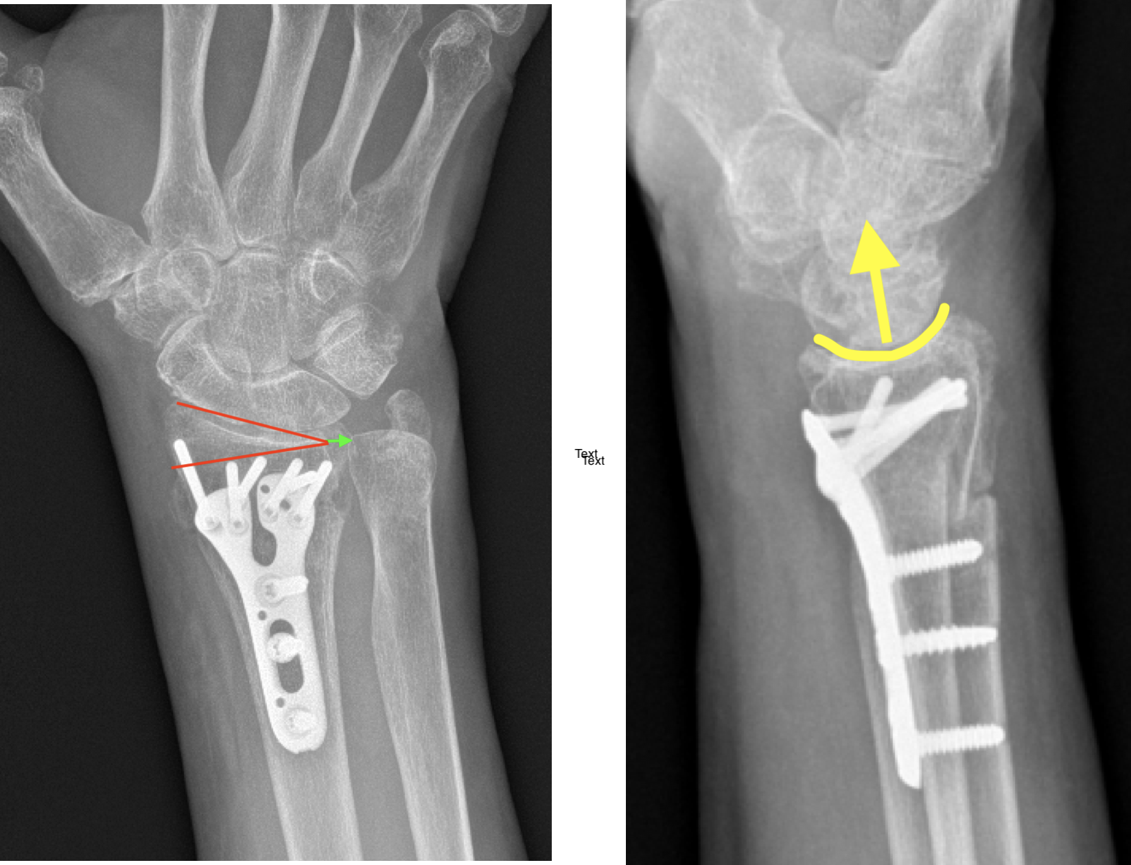 A Patient’s Guide to Distal Radius Fractures — Dr. Nick Golinvaux